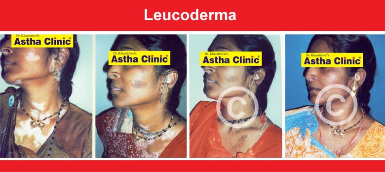 Leucoderma (White Spot)